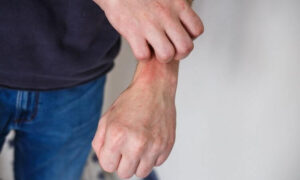 Meth Mites and Meth Sores | Midwood Addiction Treatment